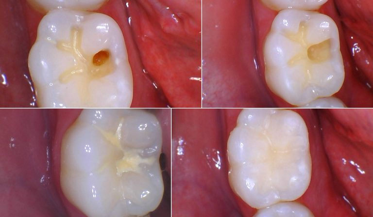 Sealants: The Good, the Bad, and the Reality - Stone Ridge Dental