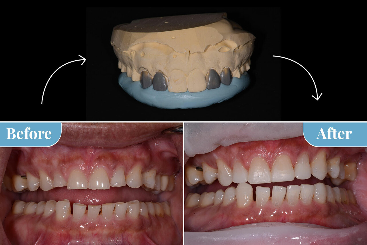 Transformative Transitional Bonding: Teeth Reshaping with Composite